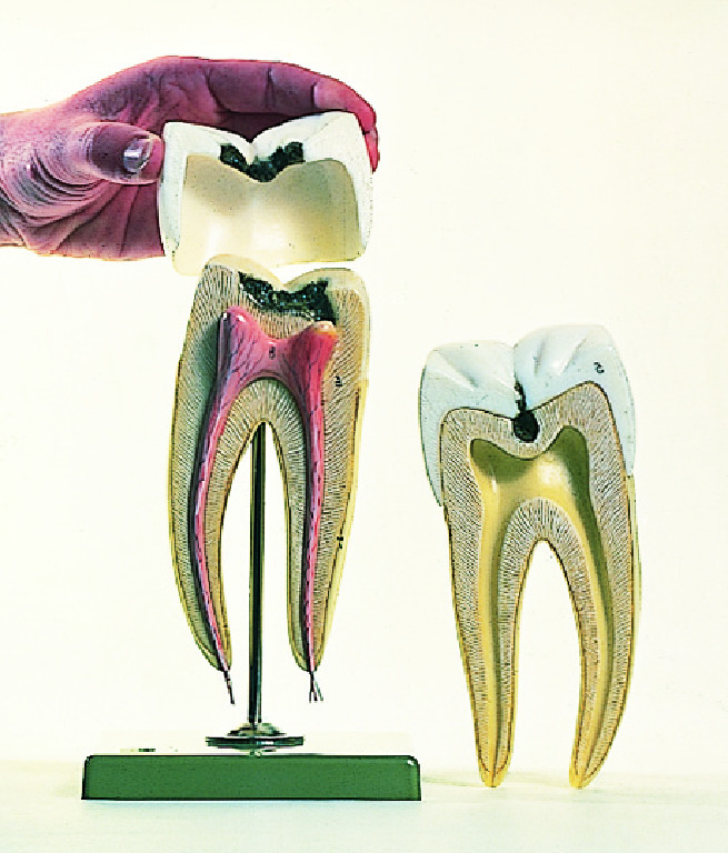 Somso® Molar With Cavities Model | Human Biology Models